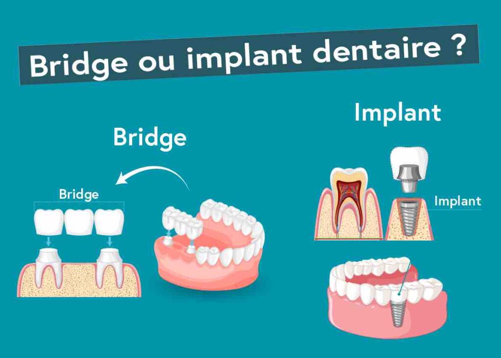 Couronne et bridge : alternatives à l'implant dentaire - Eurodentaire